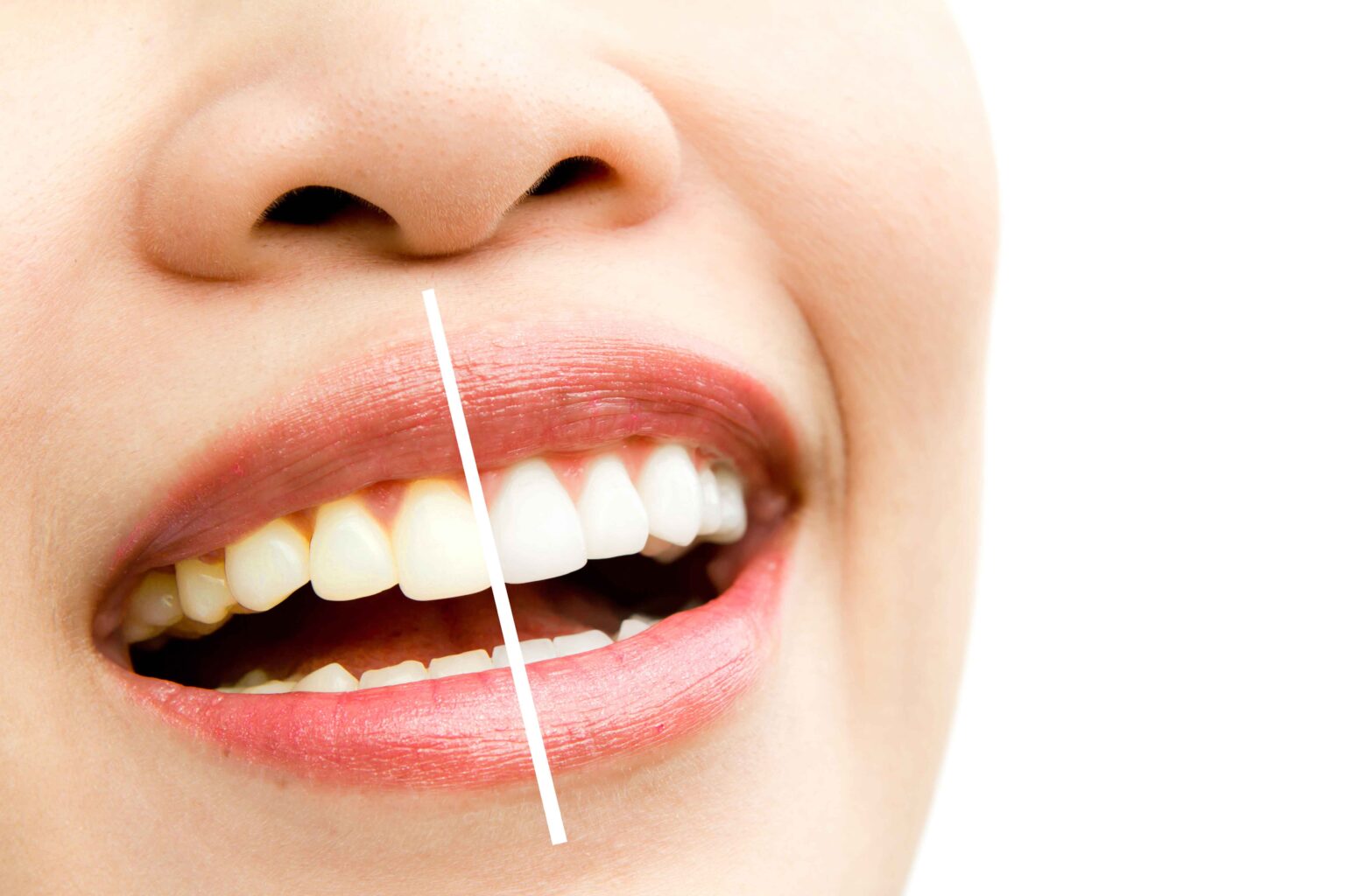 How to Whiten Teeth at Home in Just one Day